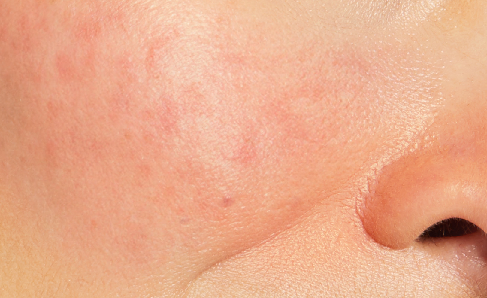 Skin Concern | Redness & Inflammation